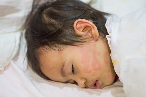 Cold Urticaria | DrGreene